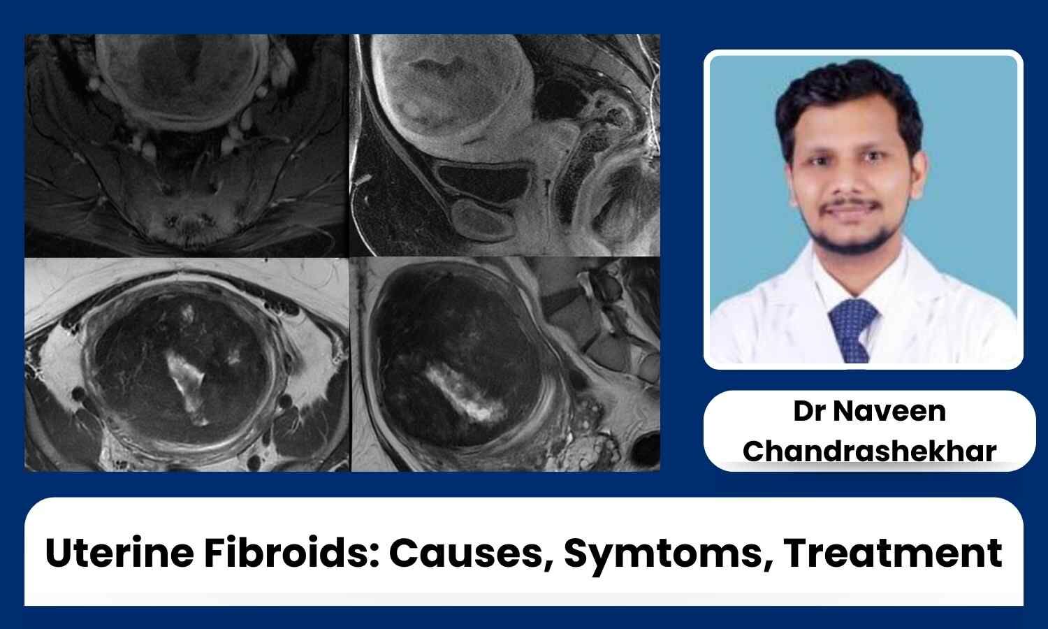 Uterine Fibroids: Insights into Causes, Symptoms, and Cutting-Edge ...