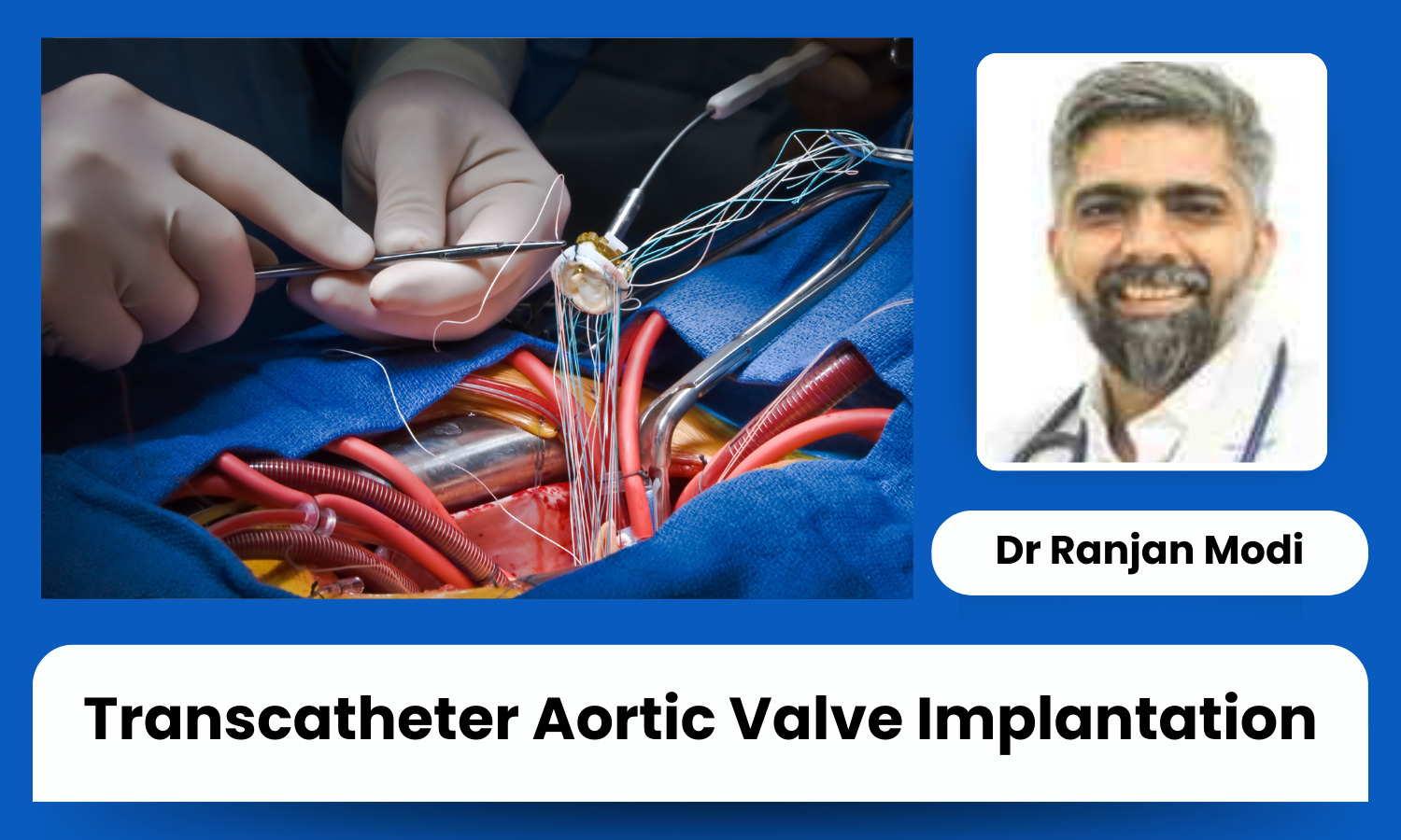 Transcatheter Aortic Valve Implantation (TAVI) and Its Impact on Heart ...