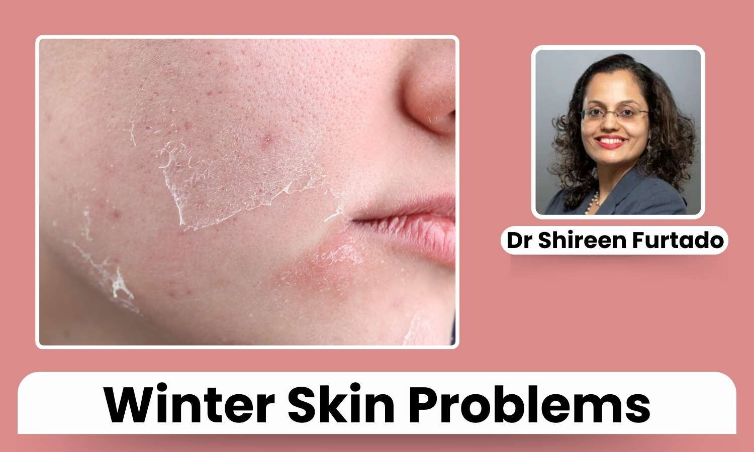 Winter Skin Problems: Managing Dry Skin and Eczema Effectively - Dr ...