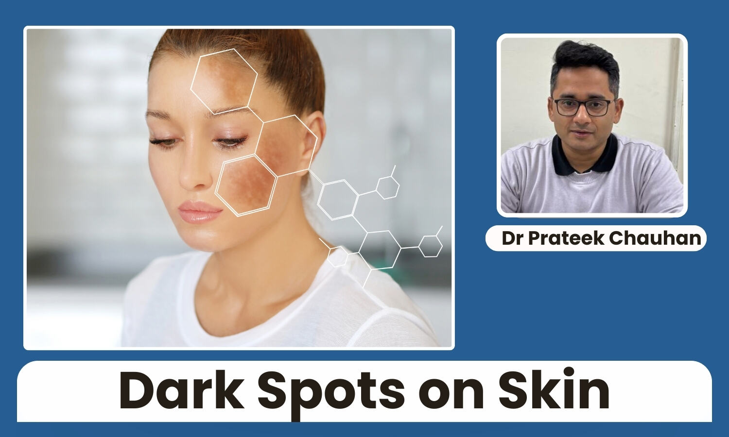 Dark Spots on Skin: Breaking Down Causes, Treatments and Prevention ...