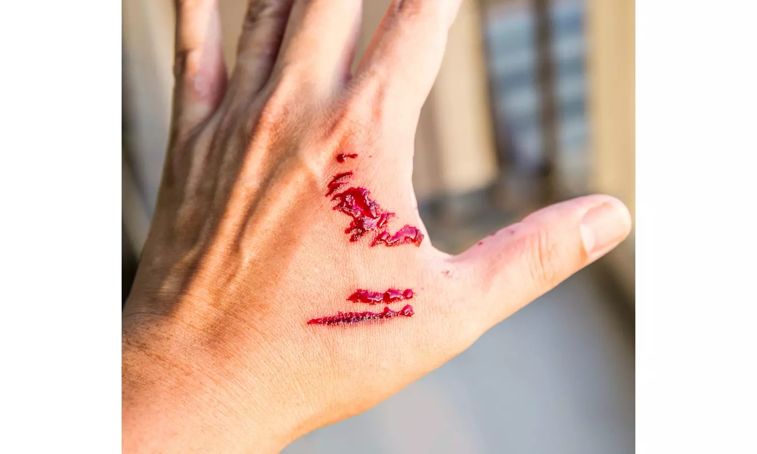 Don’t Ignore These Early Rabies Symptoms After a Bite