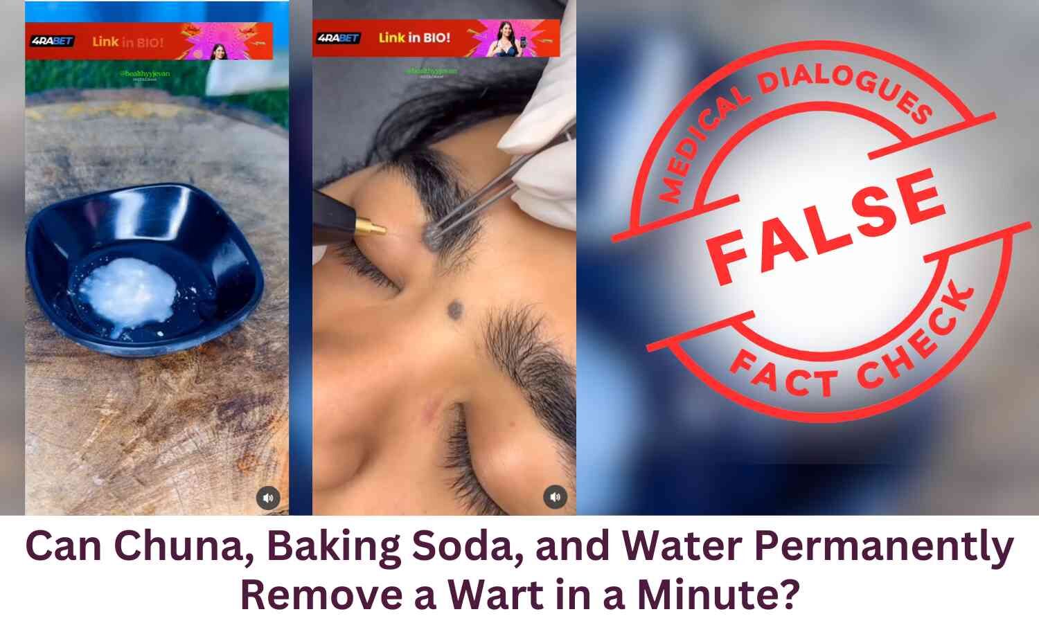 Fact Check: Can Chuna, Baking Soda, and Water Permanently Remove a Wart ...